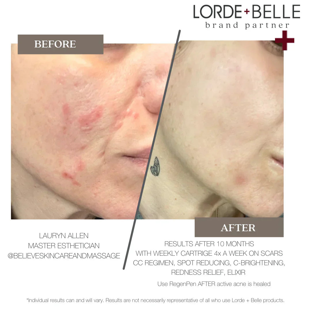 Gentle Care for Sensitive Skin: Lorde and Belle's Expert Tips – REALHER